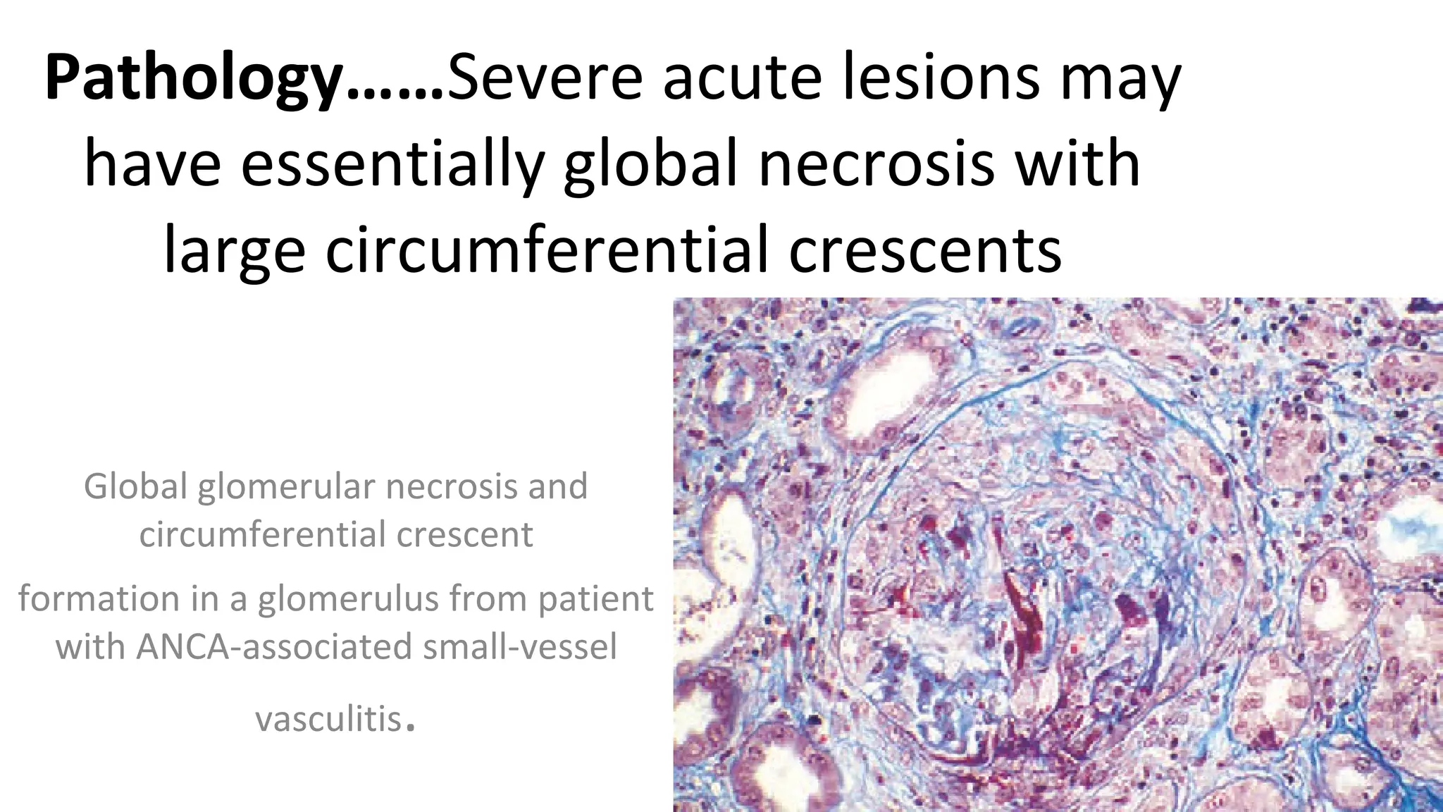 THROMBOTIC MICROANGIOPATHY | PPT
