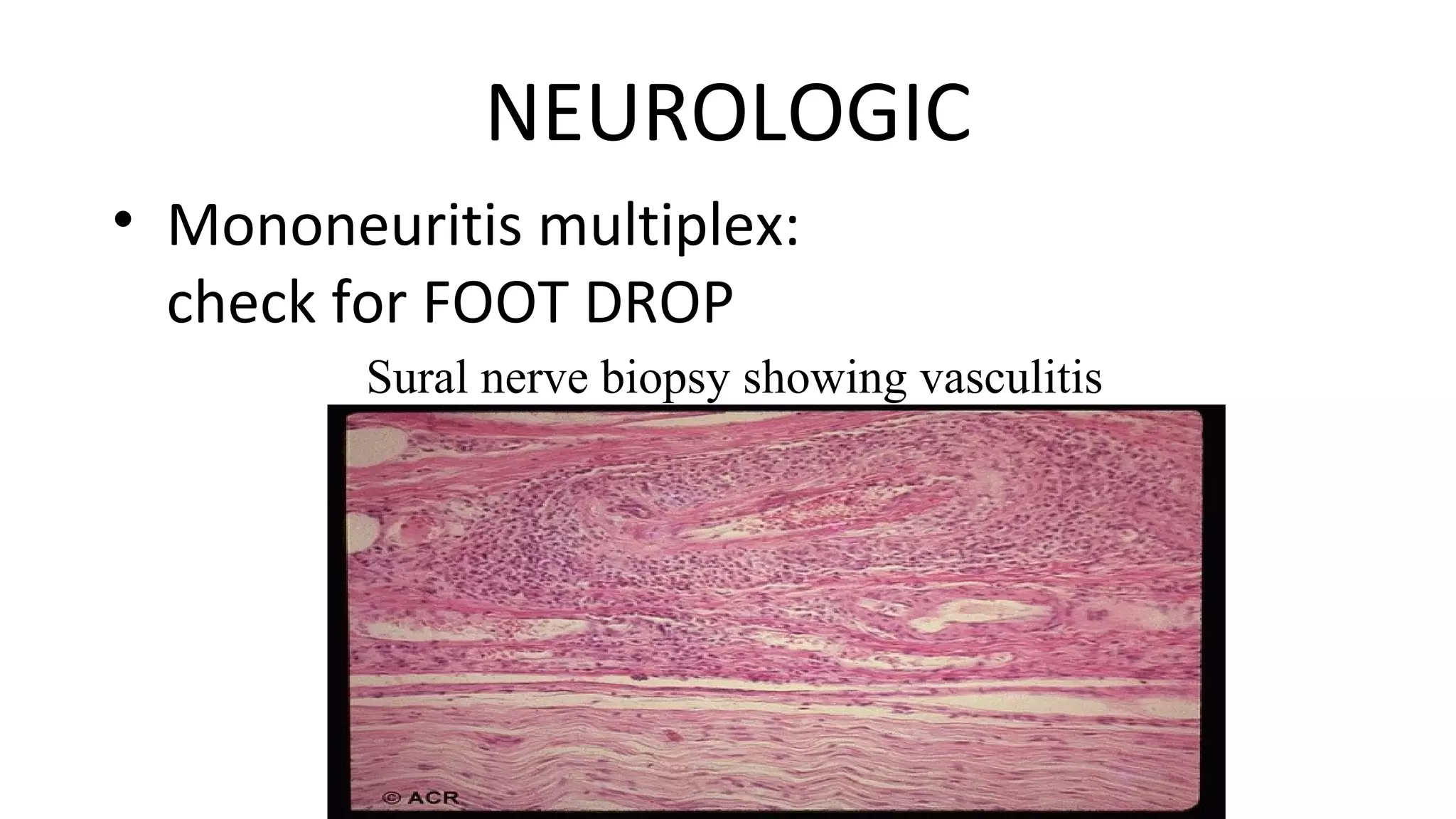 THROMBOTIC MICROANGIOPATHY | PPT
