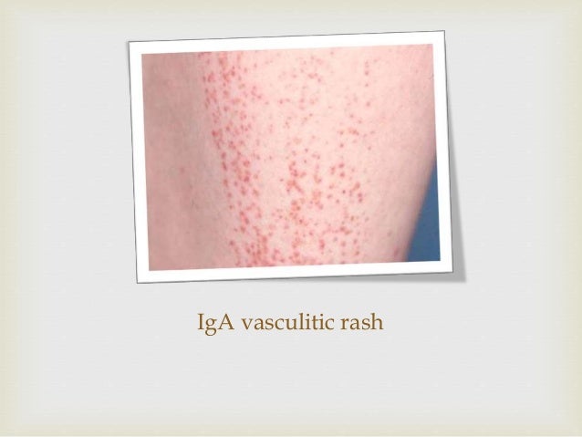 Vasculitides Emergency Presentations