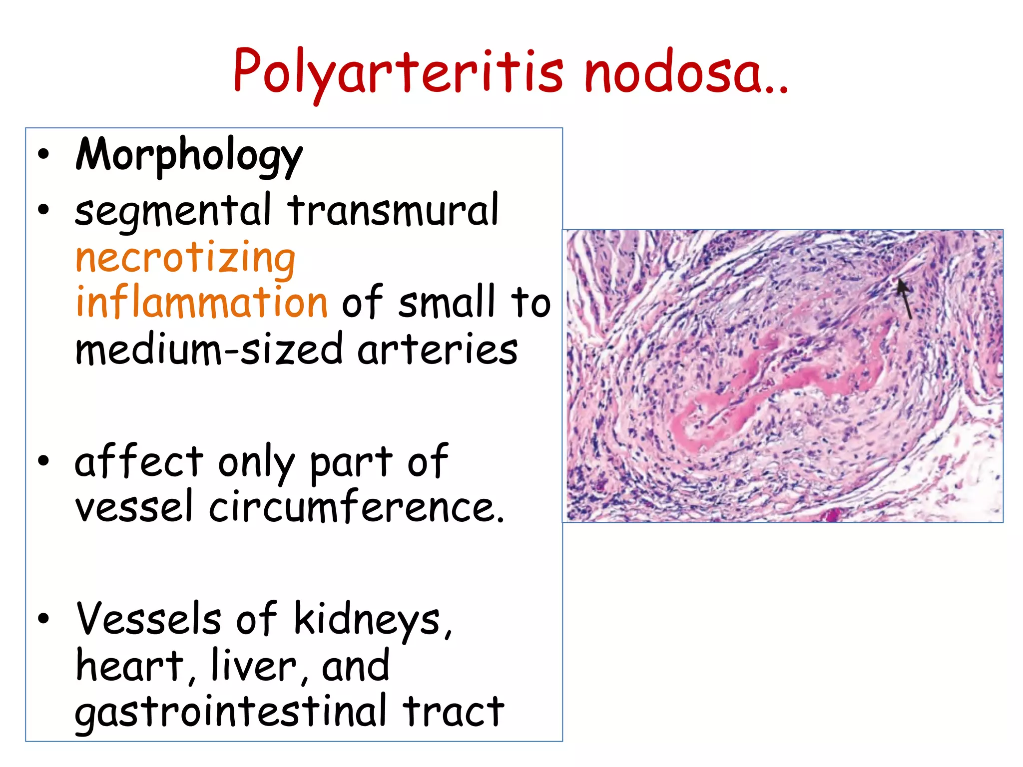 Vasculitis pathology | PDF