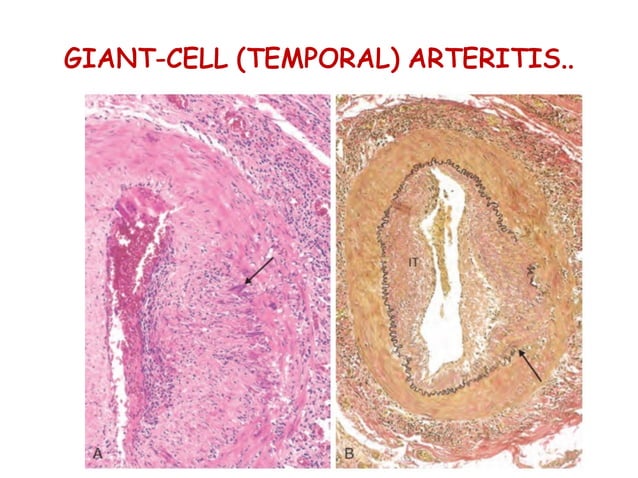 Vasculitis pathology | PDF