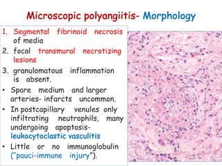 Microscopic Polyangiitis Histology