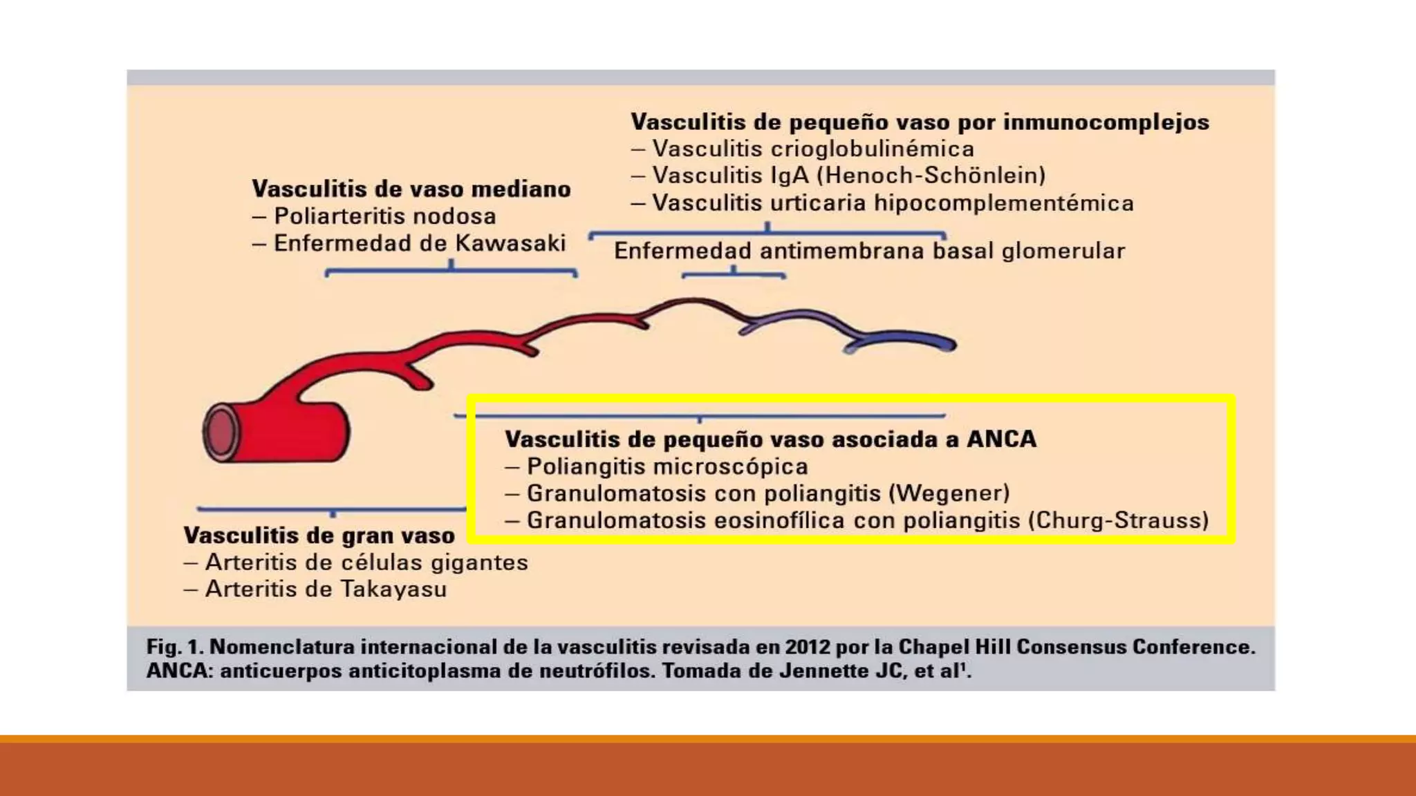 Vasculitis pequeños anca.pptx