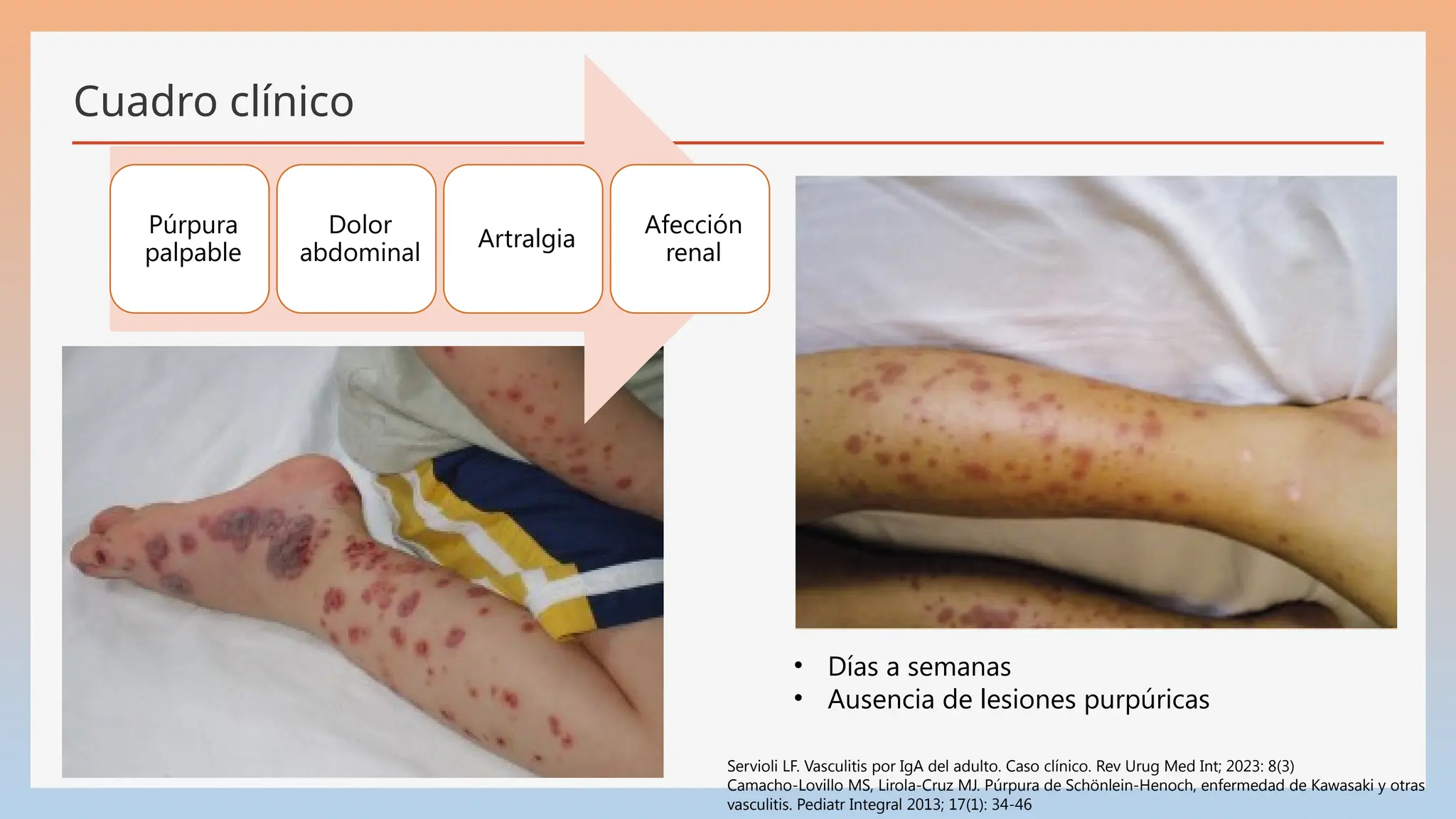 Vasculitis por IgA Purpura de Henoch Schonlein.pptx