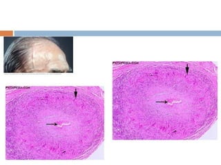 vasculitis blood vessel pathology imp pdf | PPT