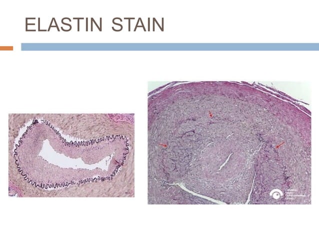 vasculitis blood vessel pathology imp pdf | PPT