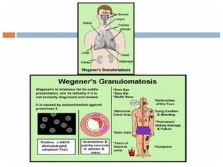 vasculitis blood vessel pathology imp pdf | PPT