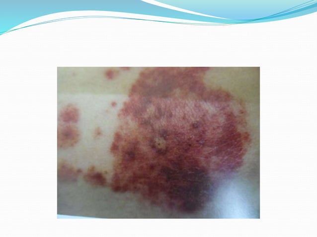 Cutaneous Vasculitis | PPTX