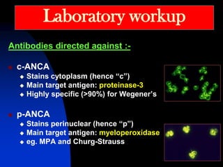 Vasculitis undergrad: diagnosis & treatment. | PDF
