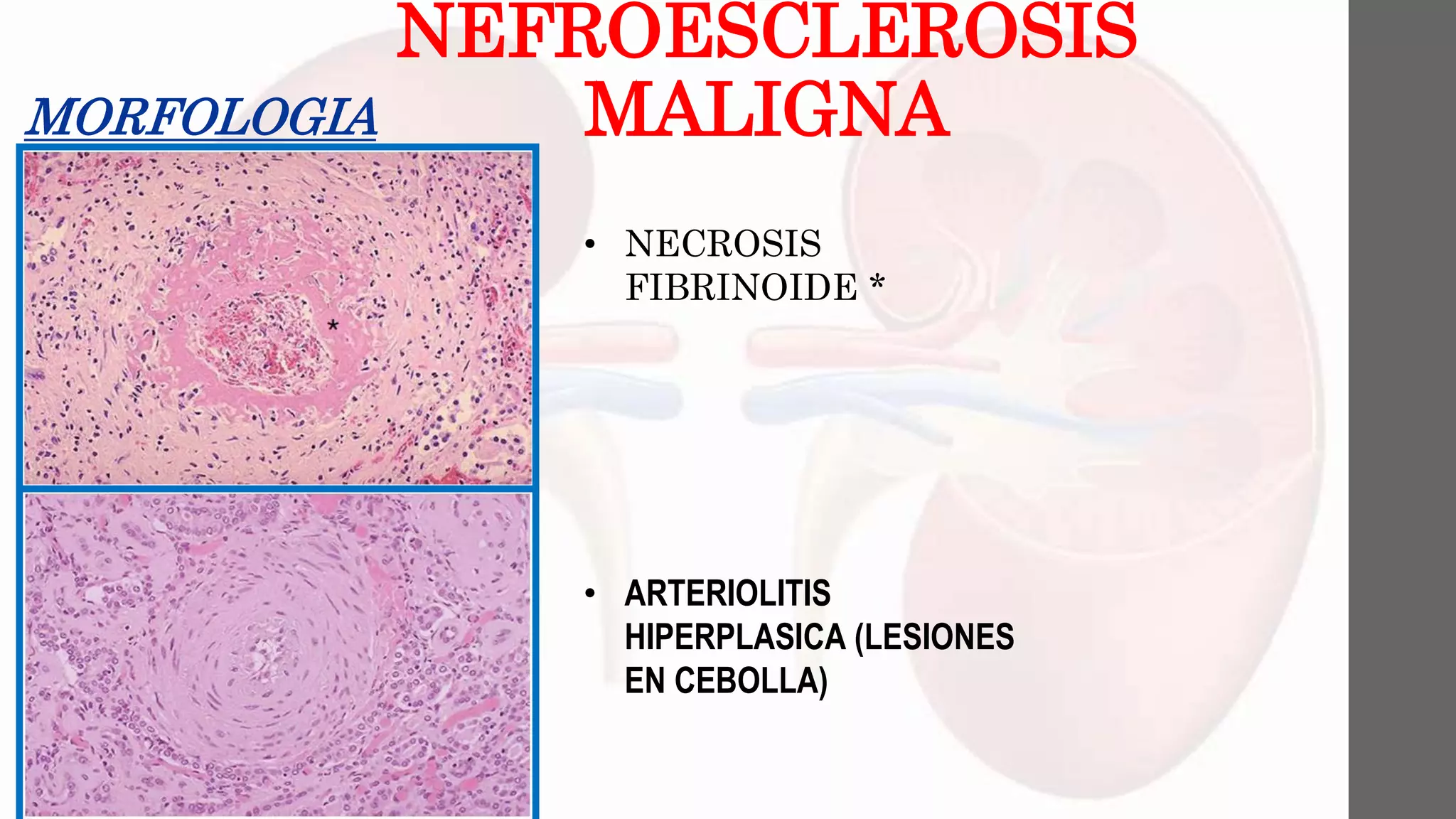 Vasculopatias renales | PPT