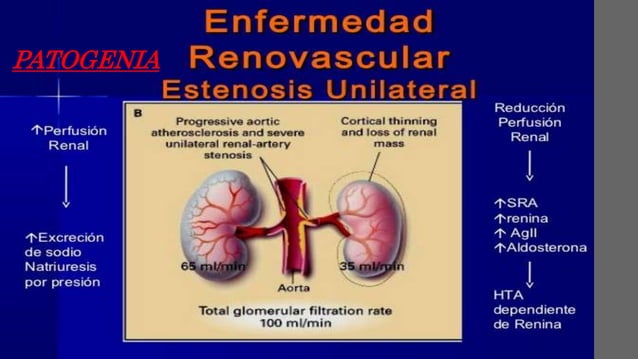 Vasculopatias renales | PPT