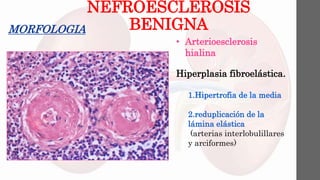 Vasculopatias renales | PPTX