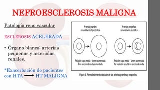 Vasculopatias renales | PPTX