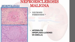 Vasculopatias renales | PPTX