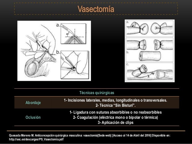 Vasectomía. Metodos AC