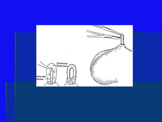 VASECTOMIA-1.ppt