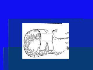 VASECTOMIA-1.ppt