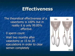 Vasectomy | PPT