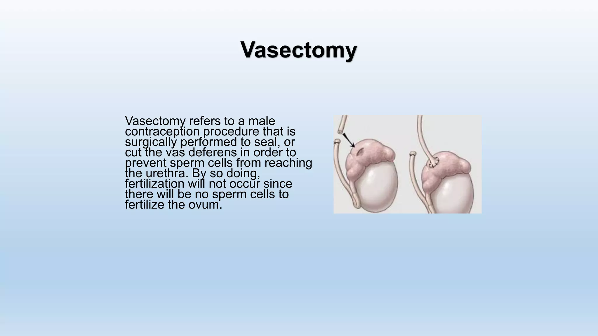 Vasectomy Reversal The Basic You Should Know Ppt Free Download