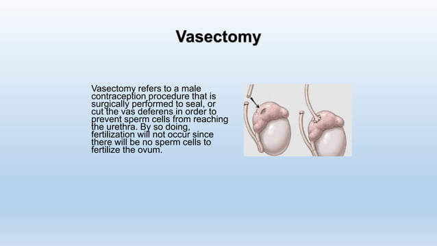 Vasectomy reversal The Basic You Should Know | PPT