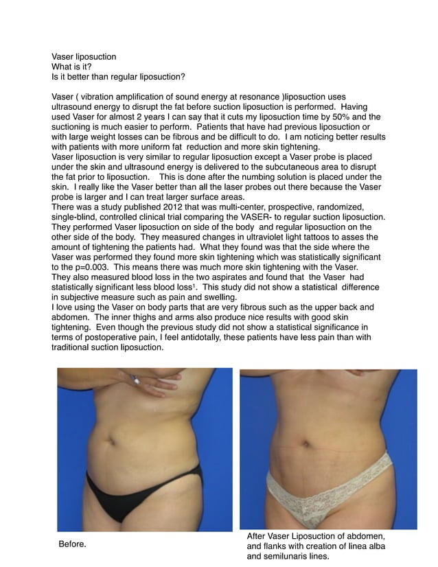 Vaser liposuction | PDF