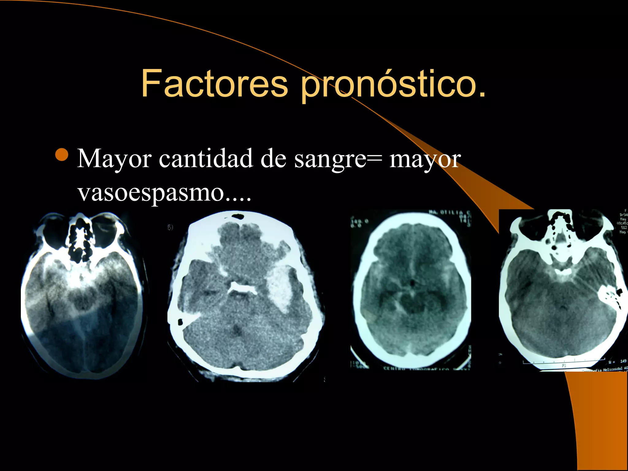 Vasoespasmo arterial cerebral. Fundamentos. | PPT