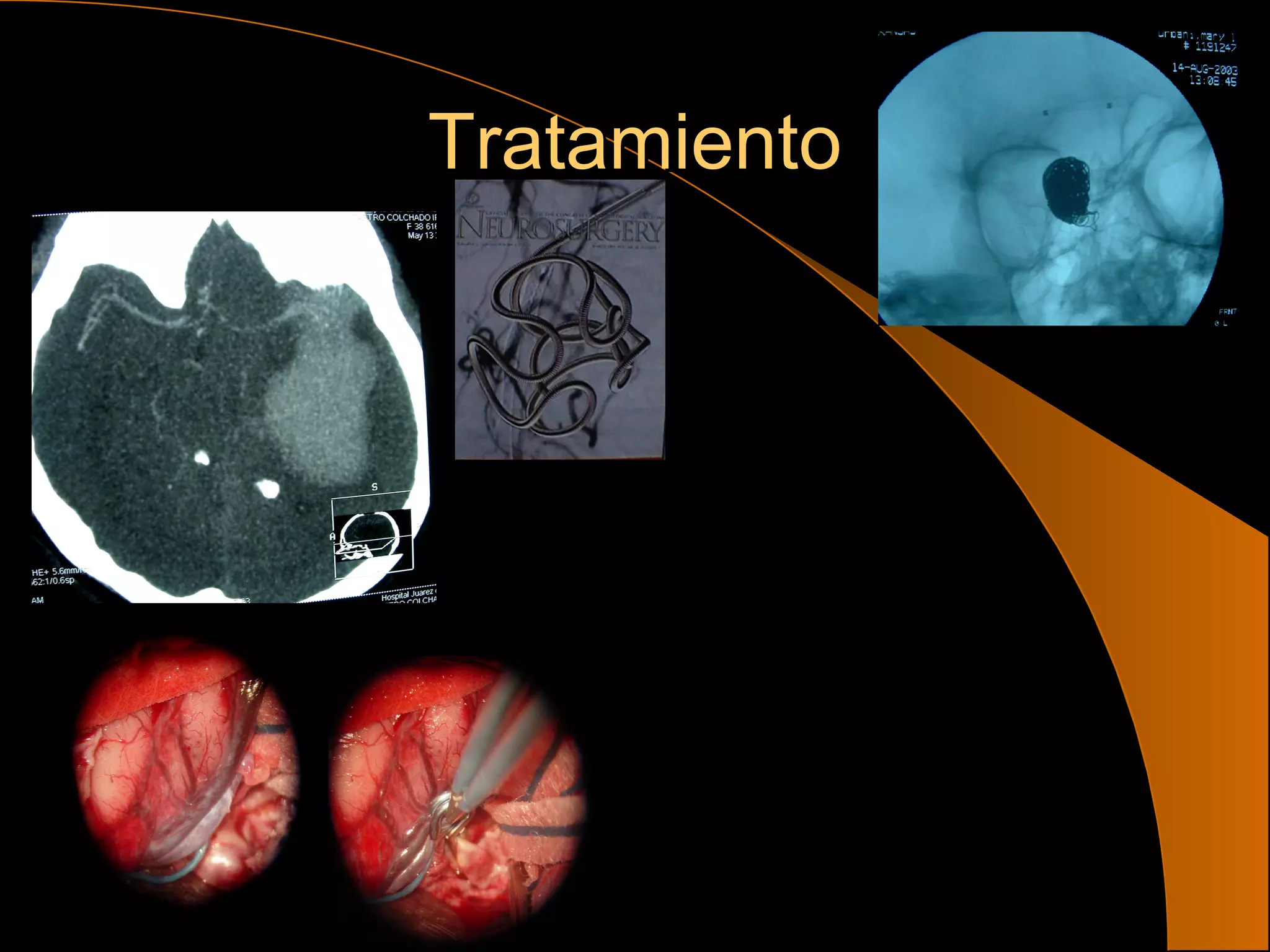 Vasoespasmo arterial cerebral. Fundamentos. | PPT