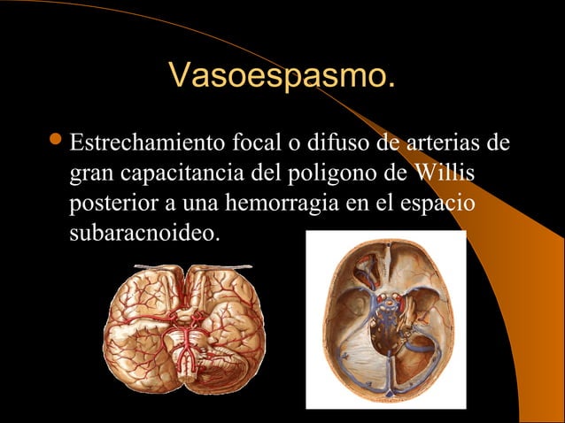 Vasoespasmo arterial cerebral. Fundamentos. | PPT
