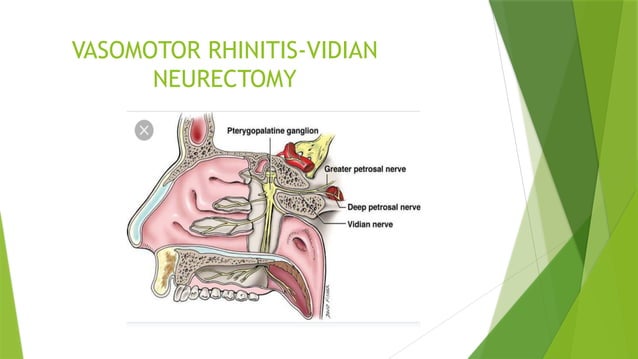 VASOMOTOR AND OTHER FORMS OF NON-ALLERGIC RHINITIS NEW.pptx
