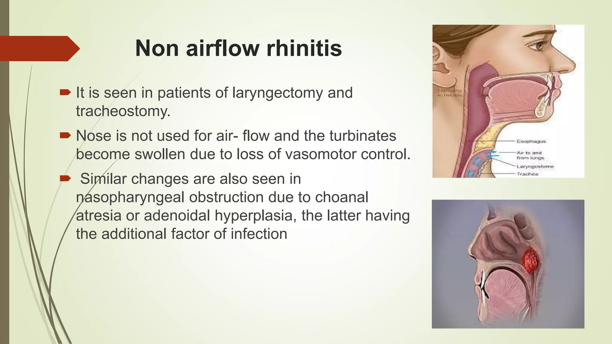 Vasomotor rhinitis and other rhinitis | PPTX