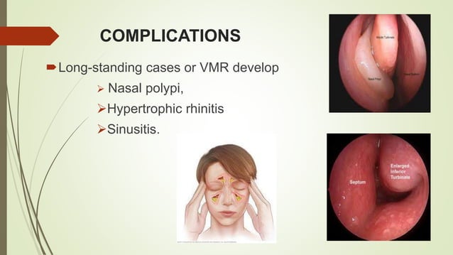 Vasomotor rhinitis and other rhinitis | PPTX