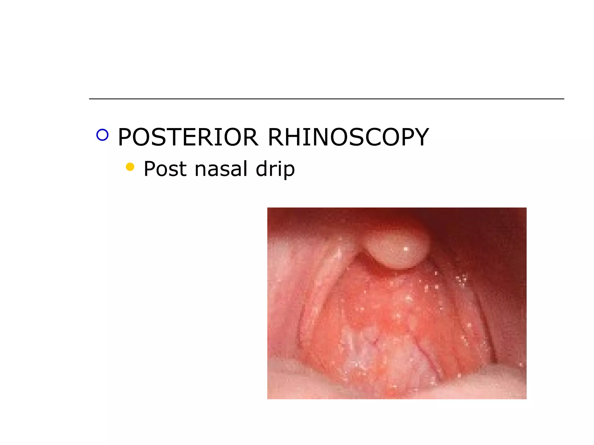 Vasomotor rhinitis & nares | PPT