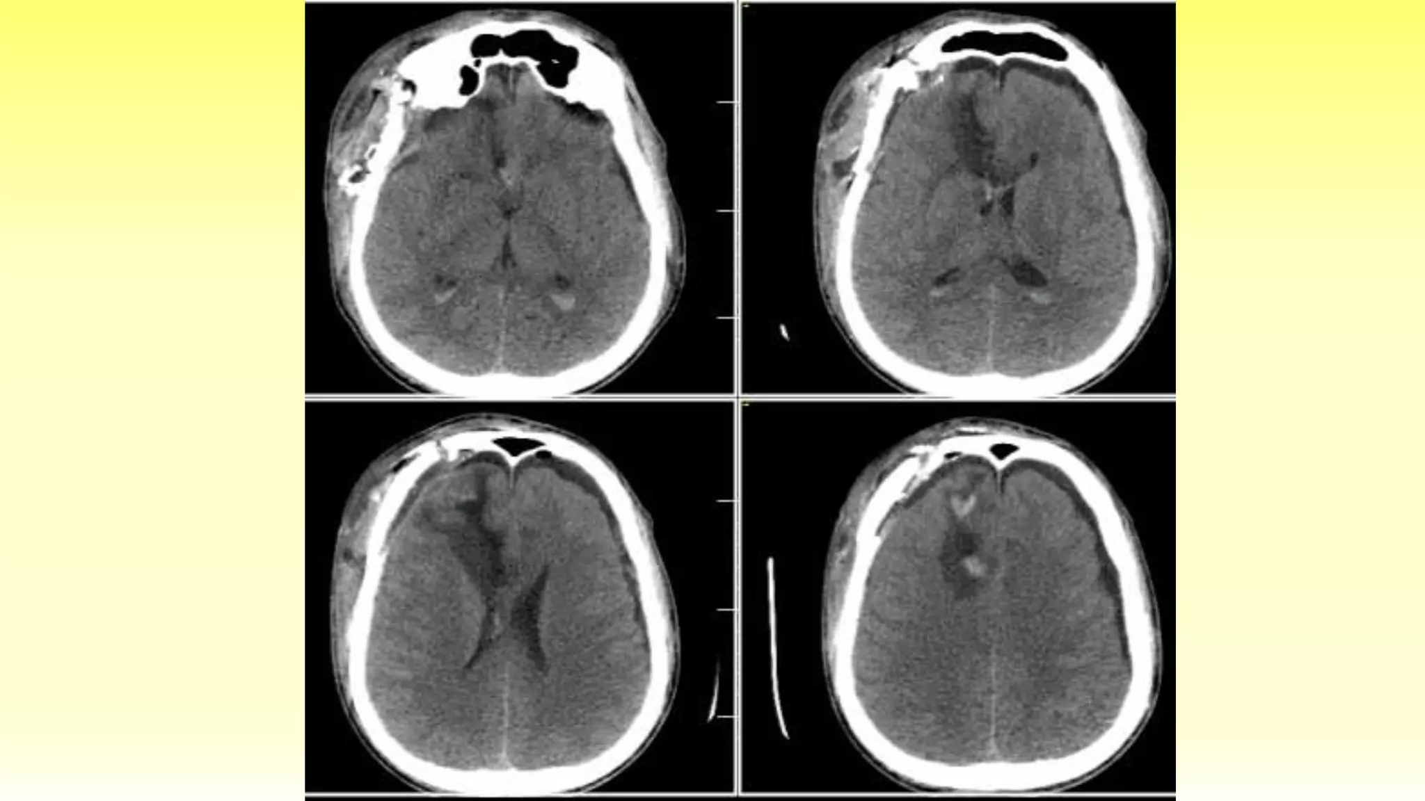 Cerebral Vasospasm | PPTX