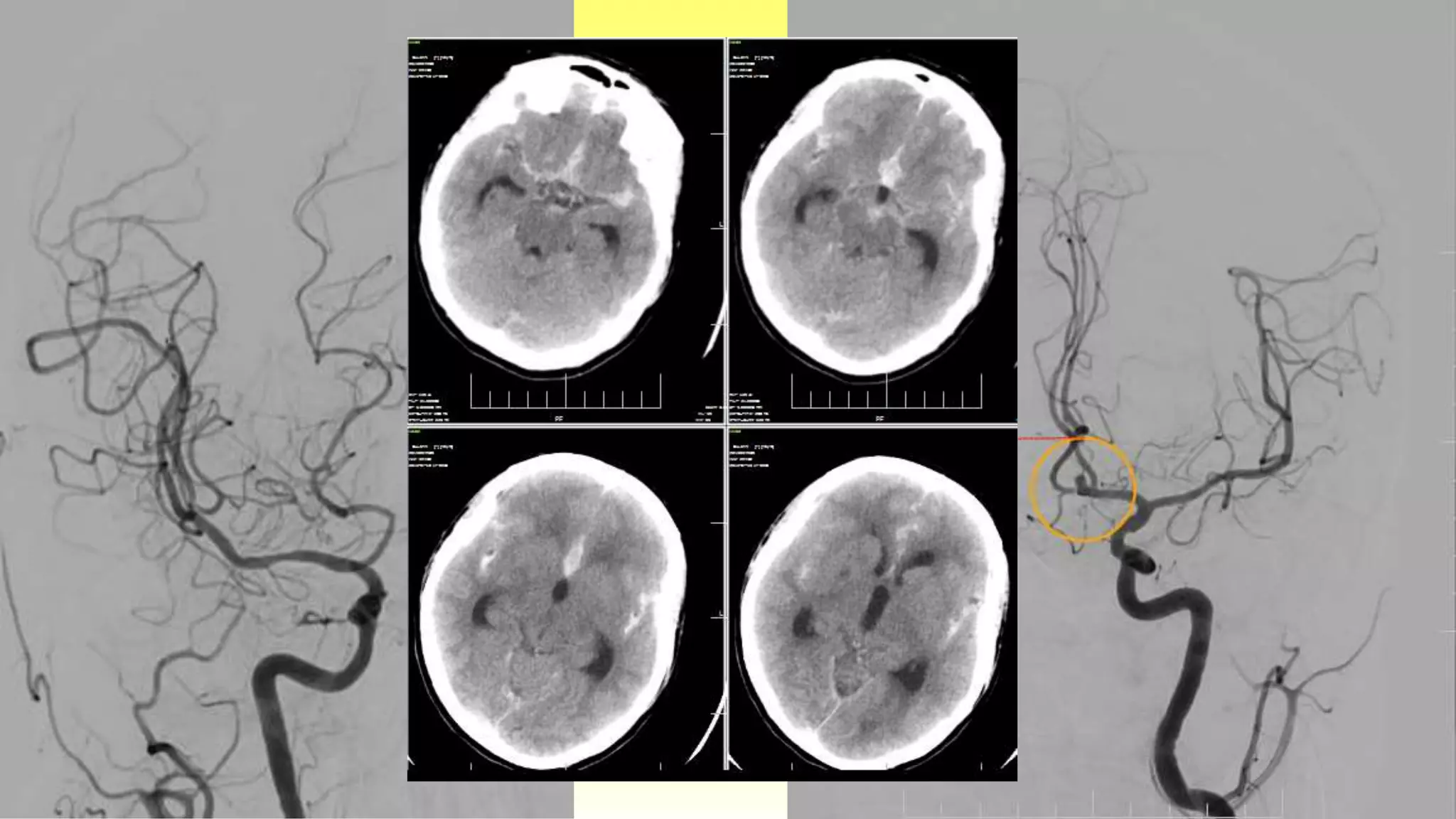Cerebral Vasospasm | PPTX