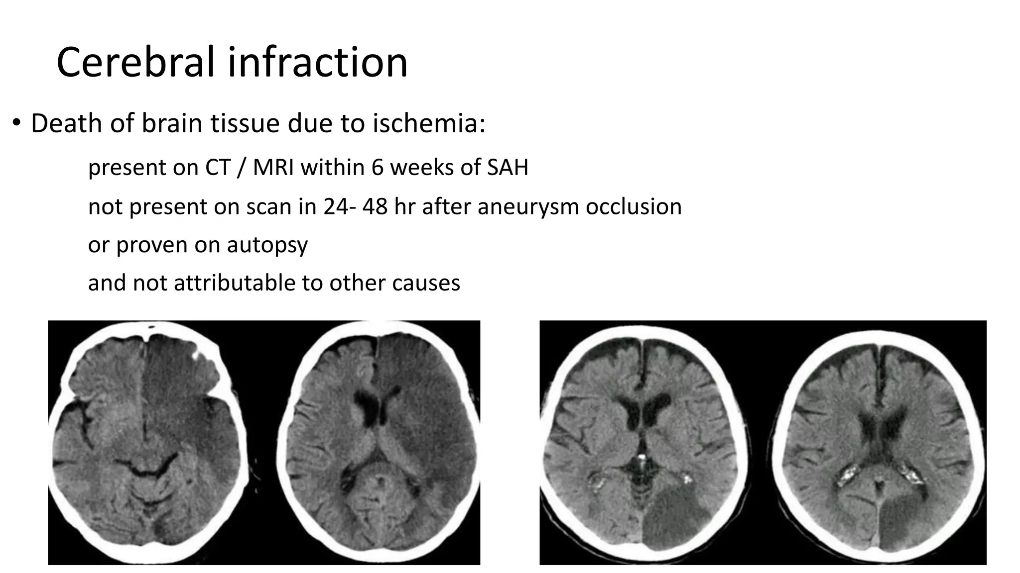 Vasospasm in subarachnoid haemorrhage pre finale | PPTX
