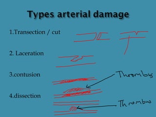 Vascular trauma | PPT