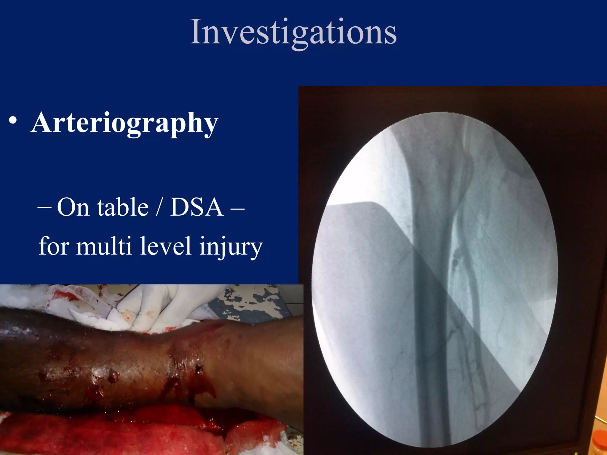 extremity Vascular trauma / injury | PPT