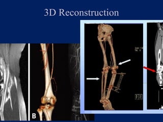extremity Vascular trauma / injury | PPT