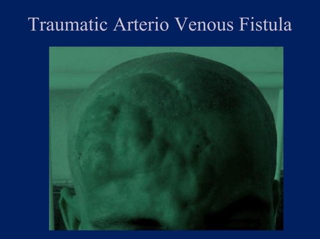extremity Vascular trauma / injury | PPT