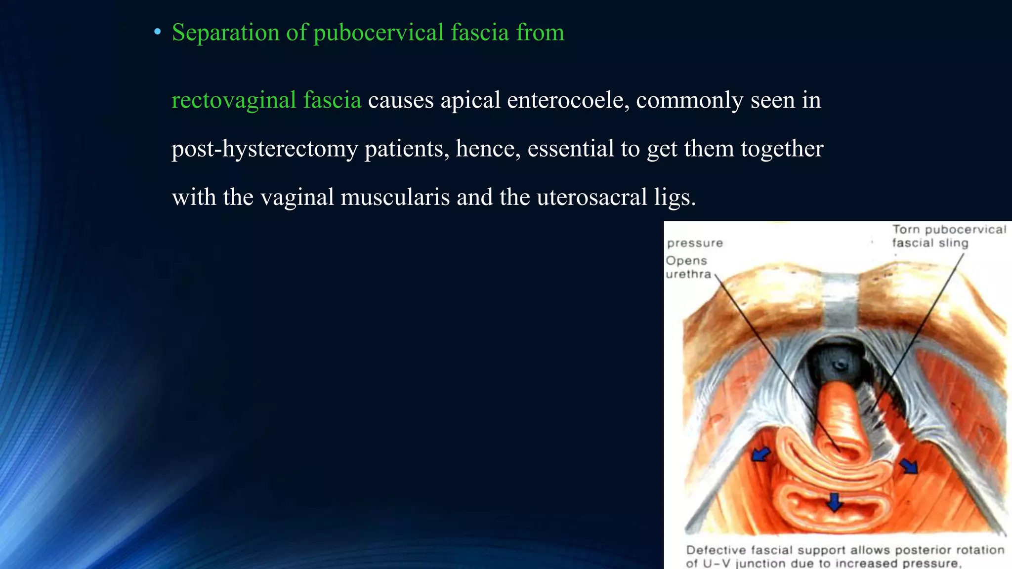 Vault prolapse, Pelvic organ Prolapse, Supports Of Uterus | PPSX