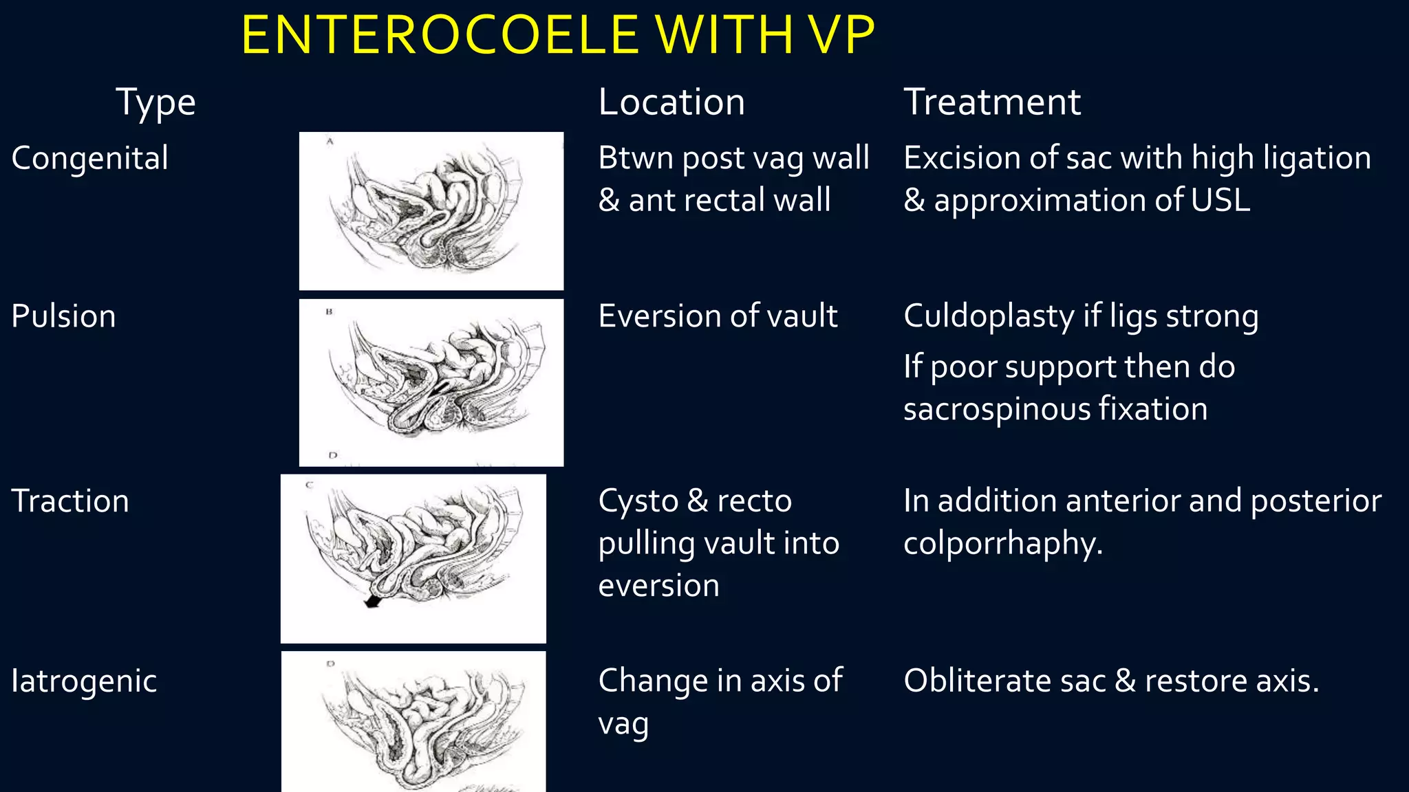 Vault prolapse, Pelvic organ Prolapse, Supports Of Uterus | PPT