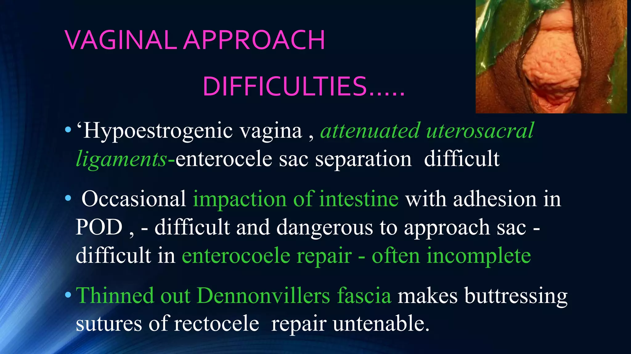 Vault prolapse, Pelvic organ Prolapse, Supports Of Uterus | PPT