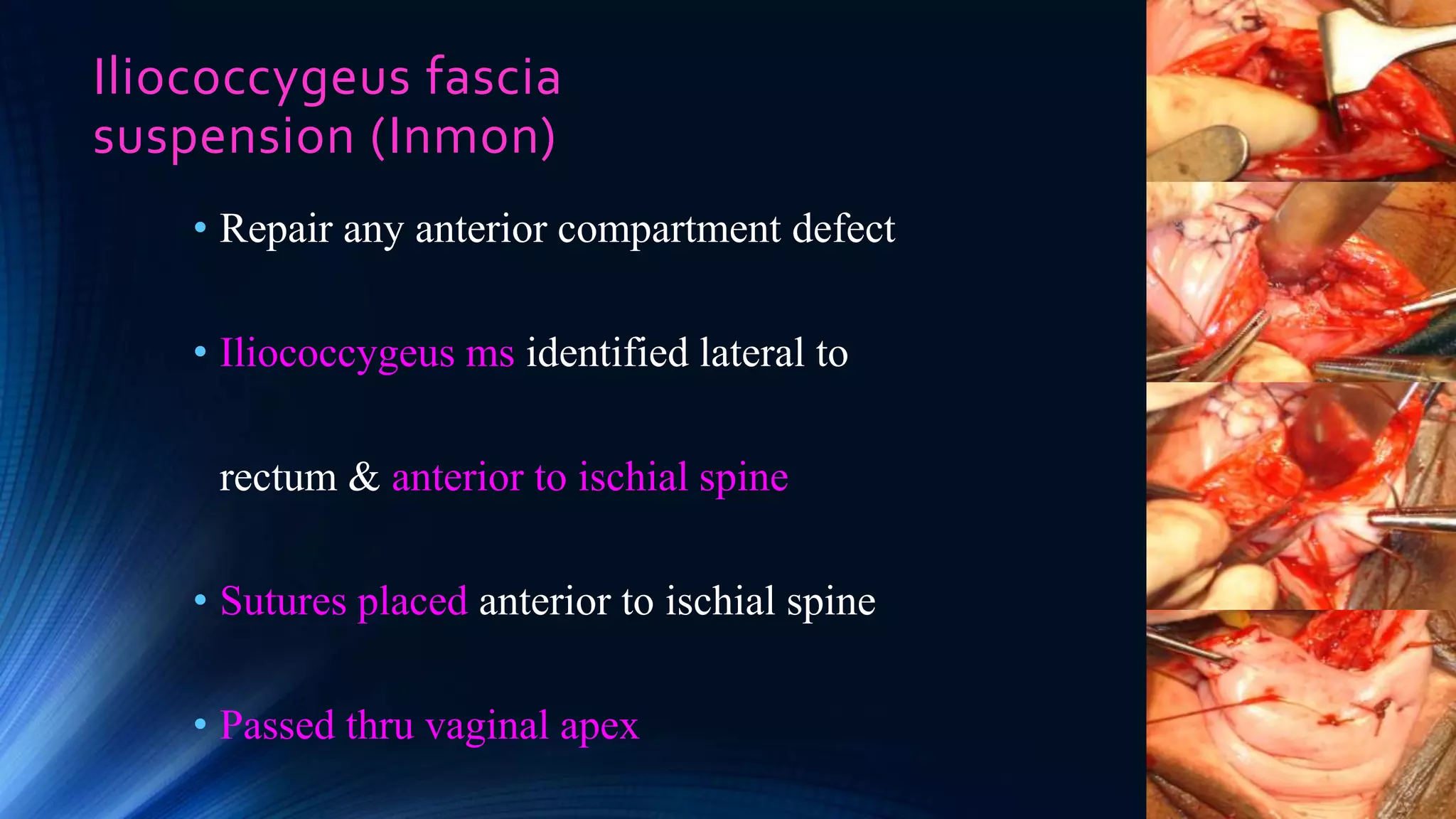 Vault prolapse, Pelvic organ Prolapse, Supports Of Uterus | PPSX