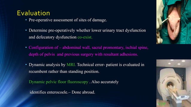 Vault prolapse, Pelvic organ Prolapse, Supports Of Uterus | PPSX