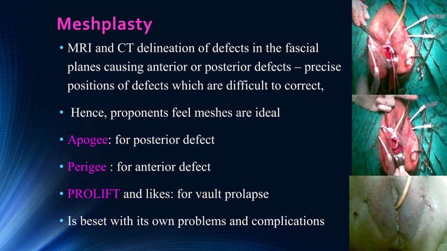 Vault prolapse, Pelvic organ Prolapse, Supports Of Uterus | PPSX