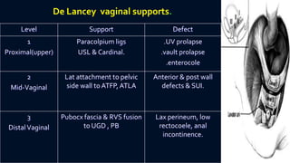 Vault prolapse, Pelvic organ Prolapse, Supports Of Uterus