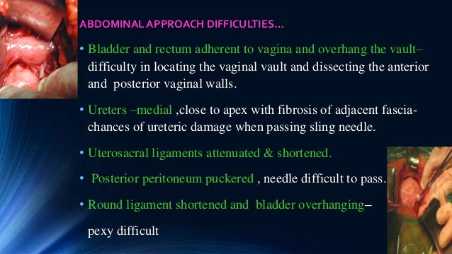 Vault Prolapse Pelvic Organ Prolapse Supports Of Uterus