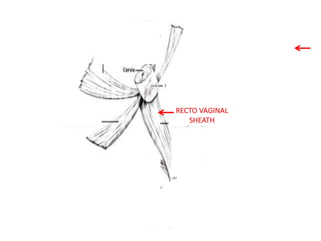 Vaginal Vault prolapse and suspension | PPTX