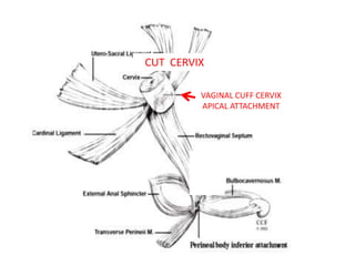 Vaginal Vault prolapse and suspension | PPTX
