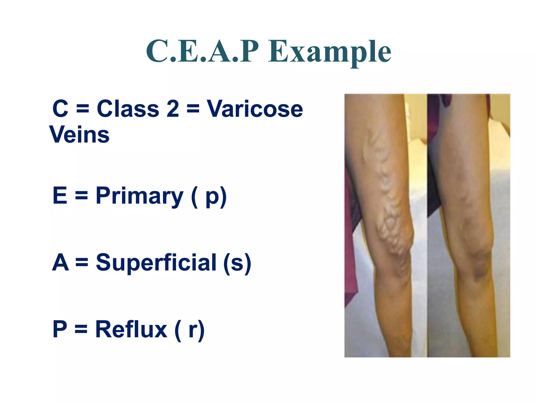 VARICOSE VEIN.pptx